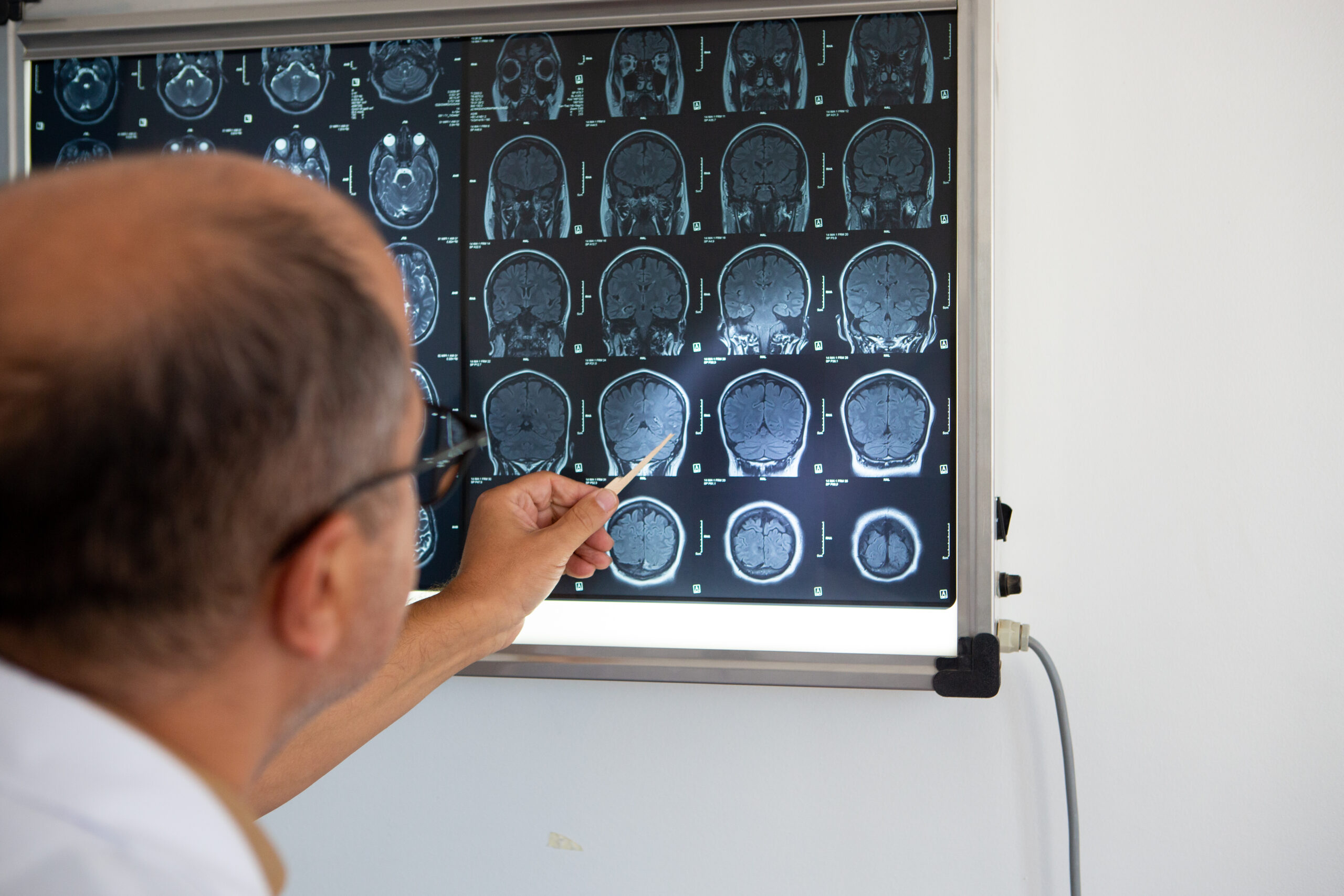 Is it MS or something else? - MS International Federation